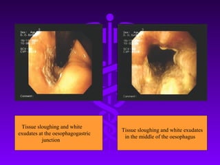 Caustic injury | PPT