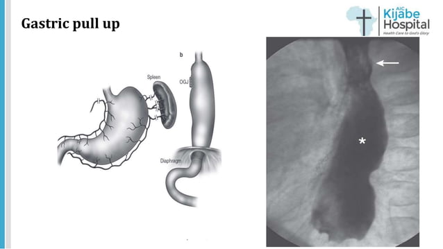 Caustic Injury and Esophageal Replacement.pptx