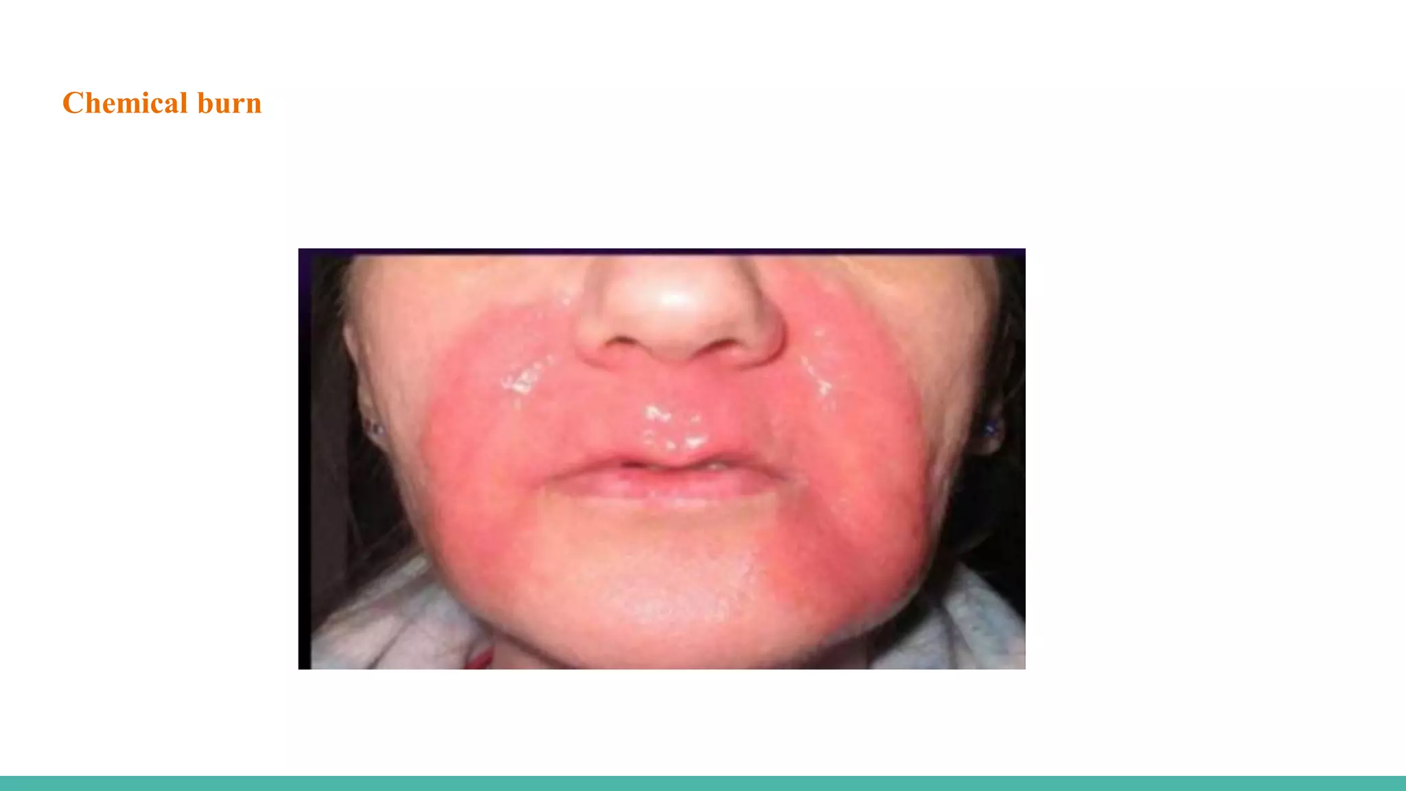 Caustics - Alkali | PPTX