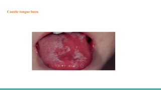 Caustics - Alkali | PPTX