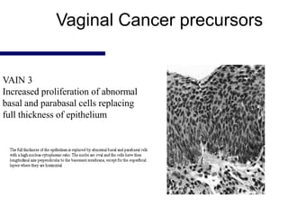Carcinoma vagina dr.kiran | PPTX