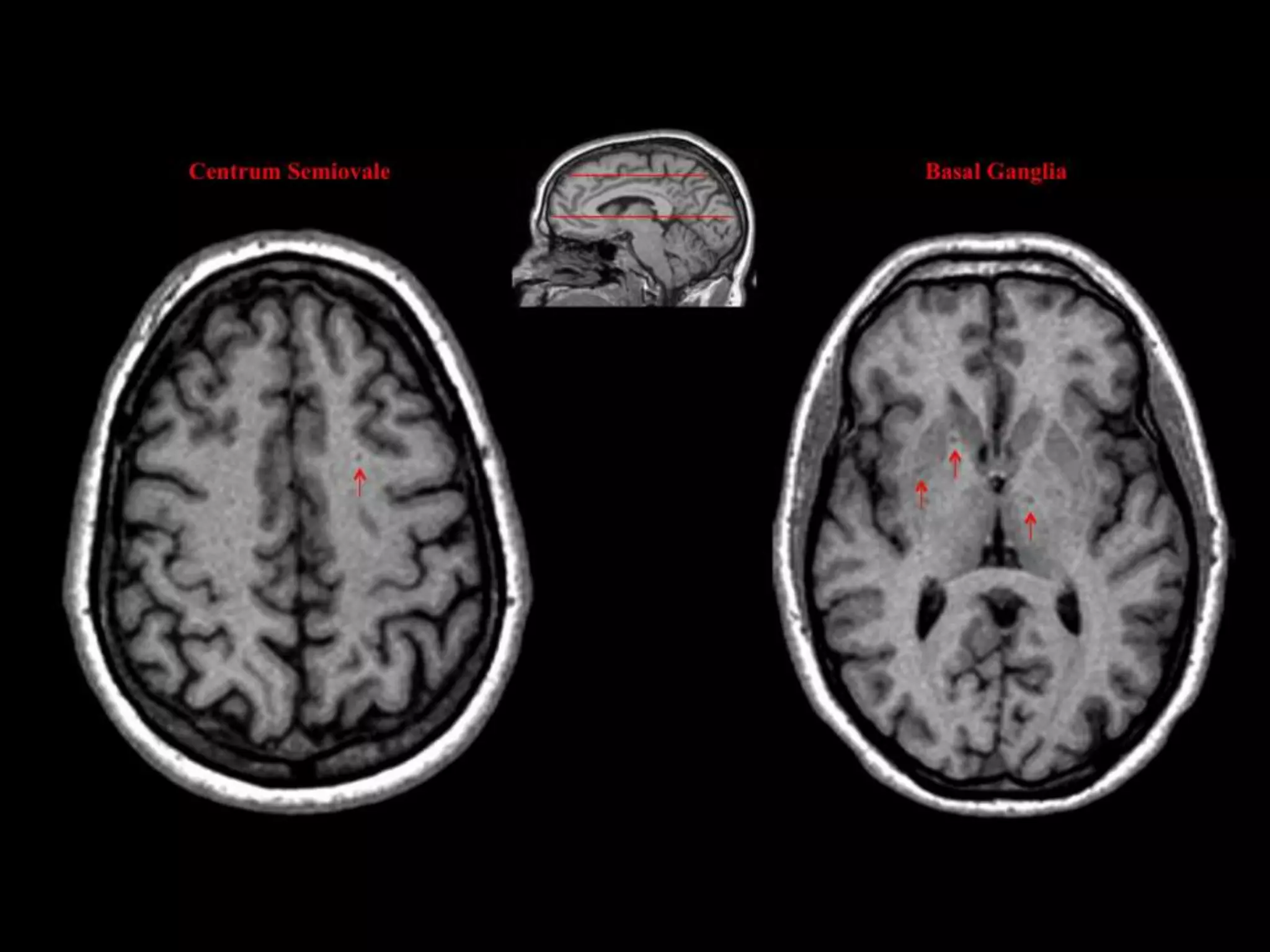 The glymphatic system in sleep and neurodegenerative diseases | PPTX