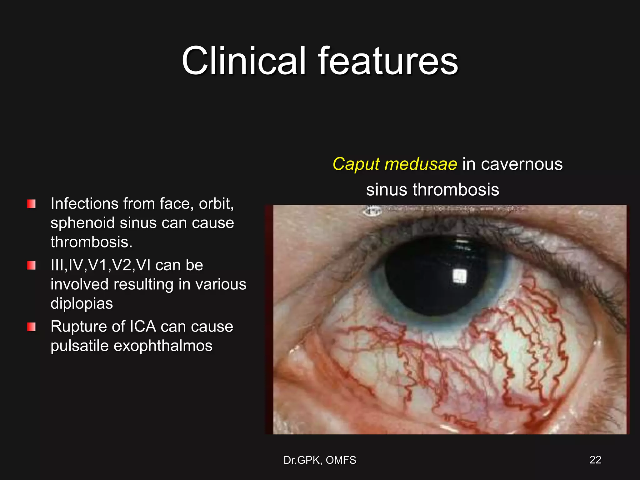 Cavenous sinus thrombosis | PPTX