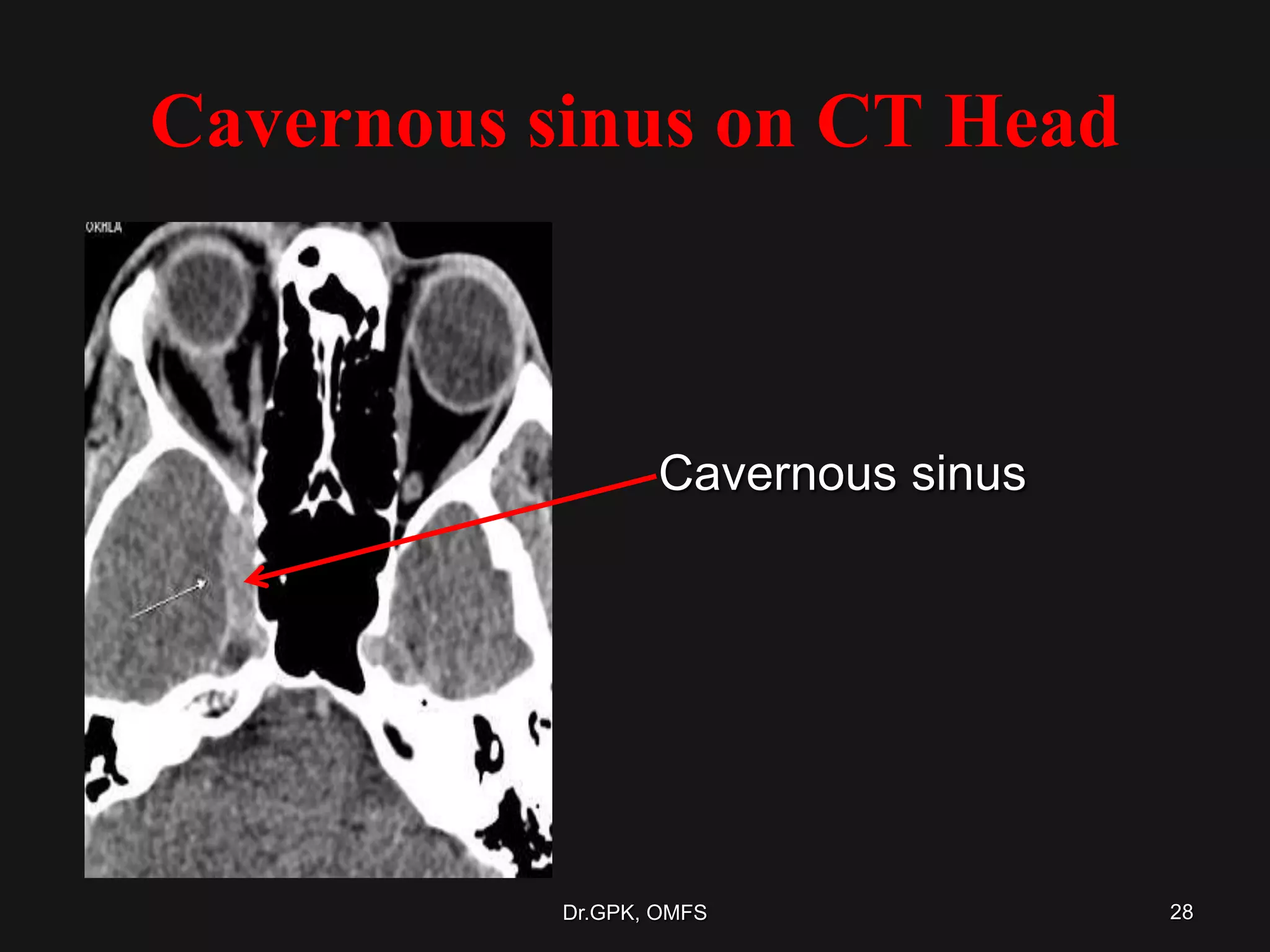 Cavenous sinus thrombosis | PPTX