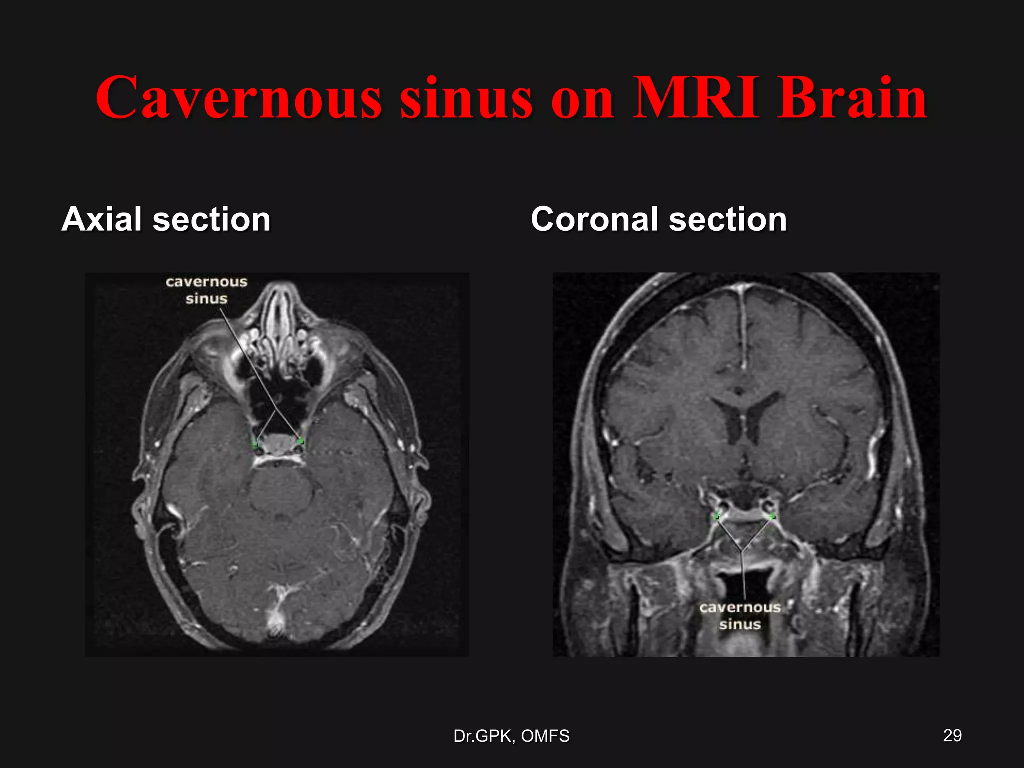 Cavenous sinus thrombosis | PPTX