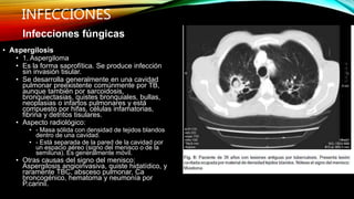 Caverna pulmonar | PPTX