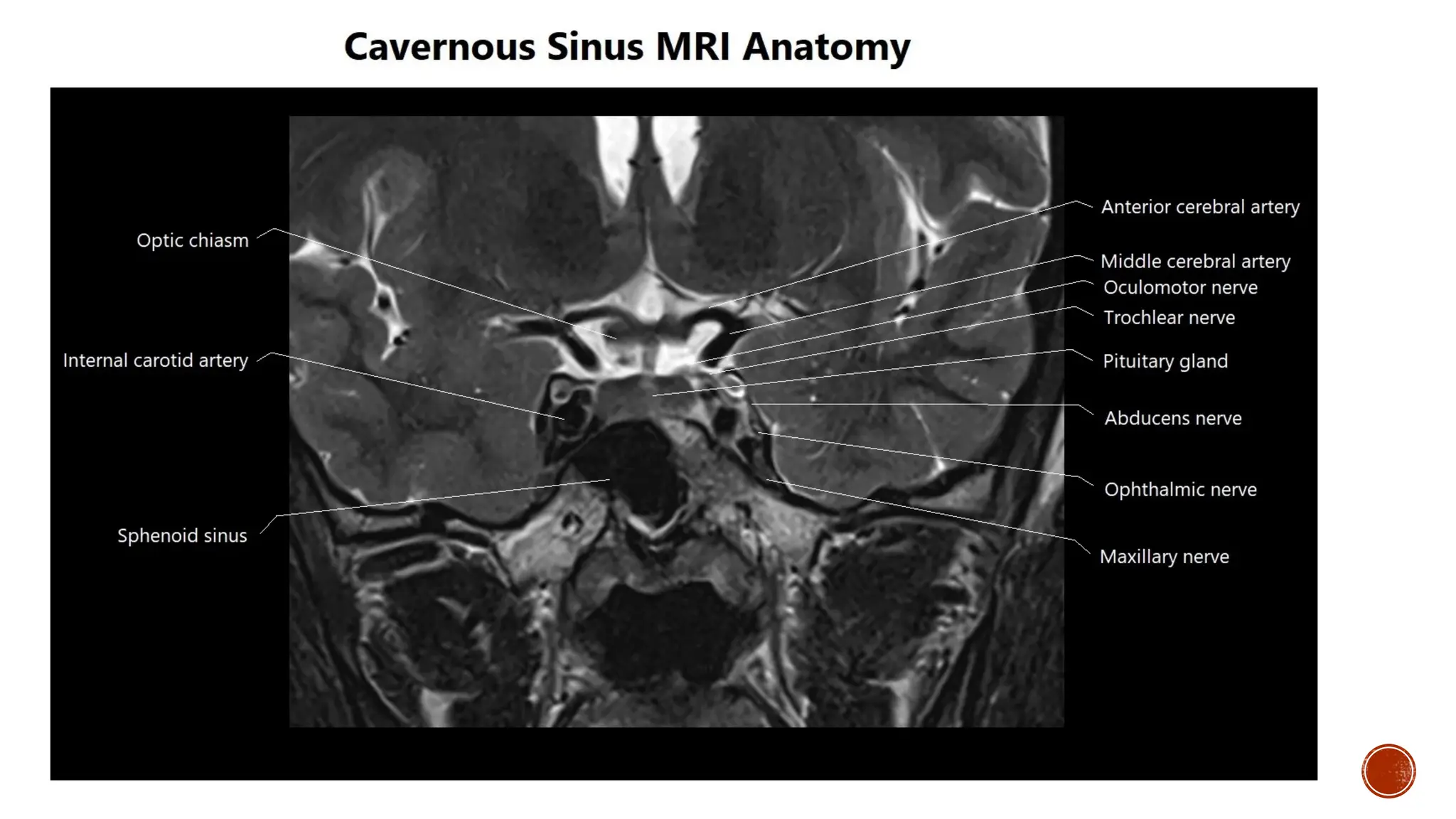 cavernous sinus anatomy and its contents.pptx