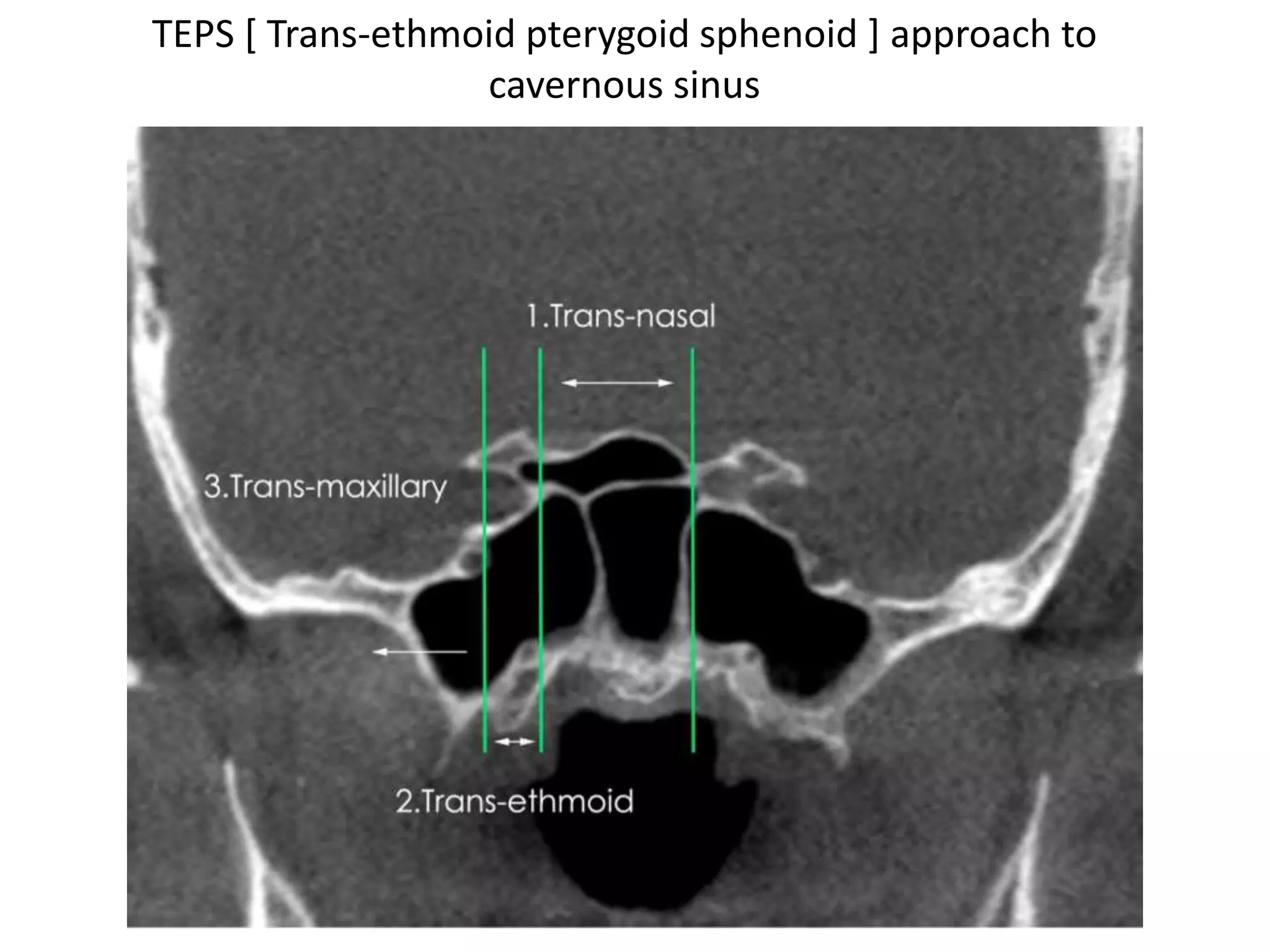 Cavernous sinus 360° | PPTX
