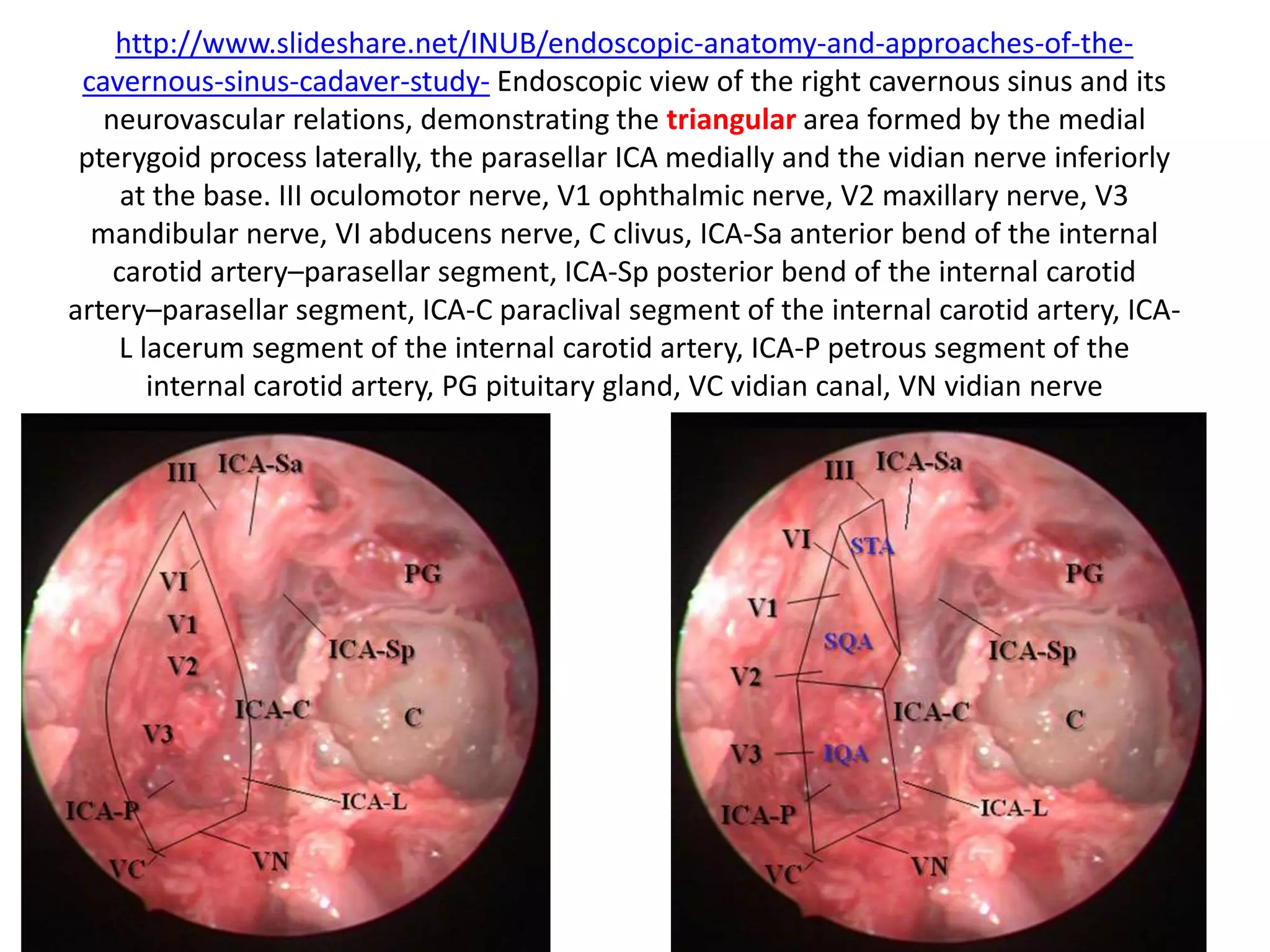 Cavernous Sinus 360° Ppt