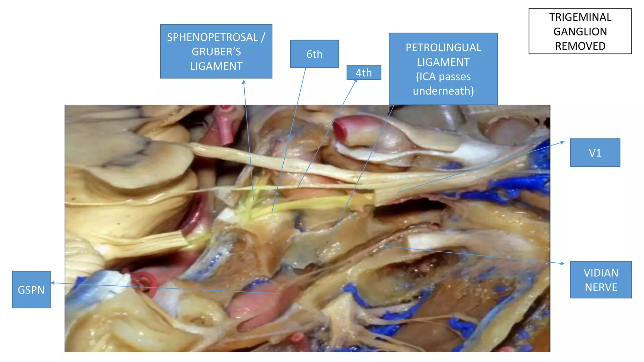Cavernous sinus-ANATOMY AND SURGICAL APPROACHES | PPTX