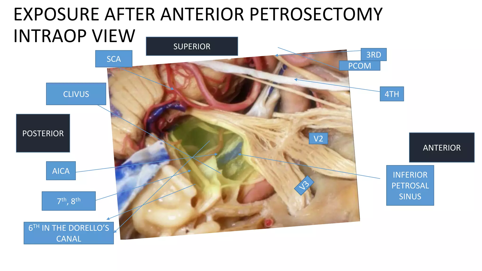 Cavernous sinus-ANATOMY AND SURGICAL APPROACHES | PPTX
