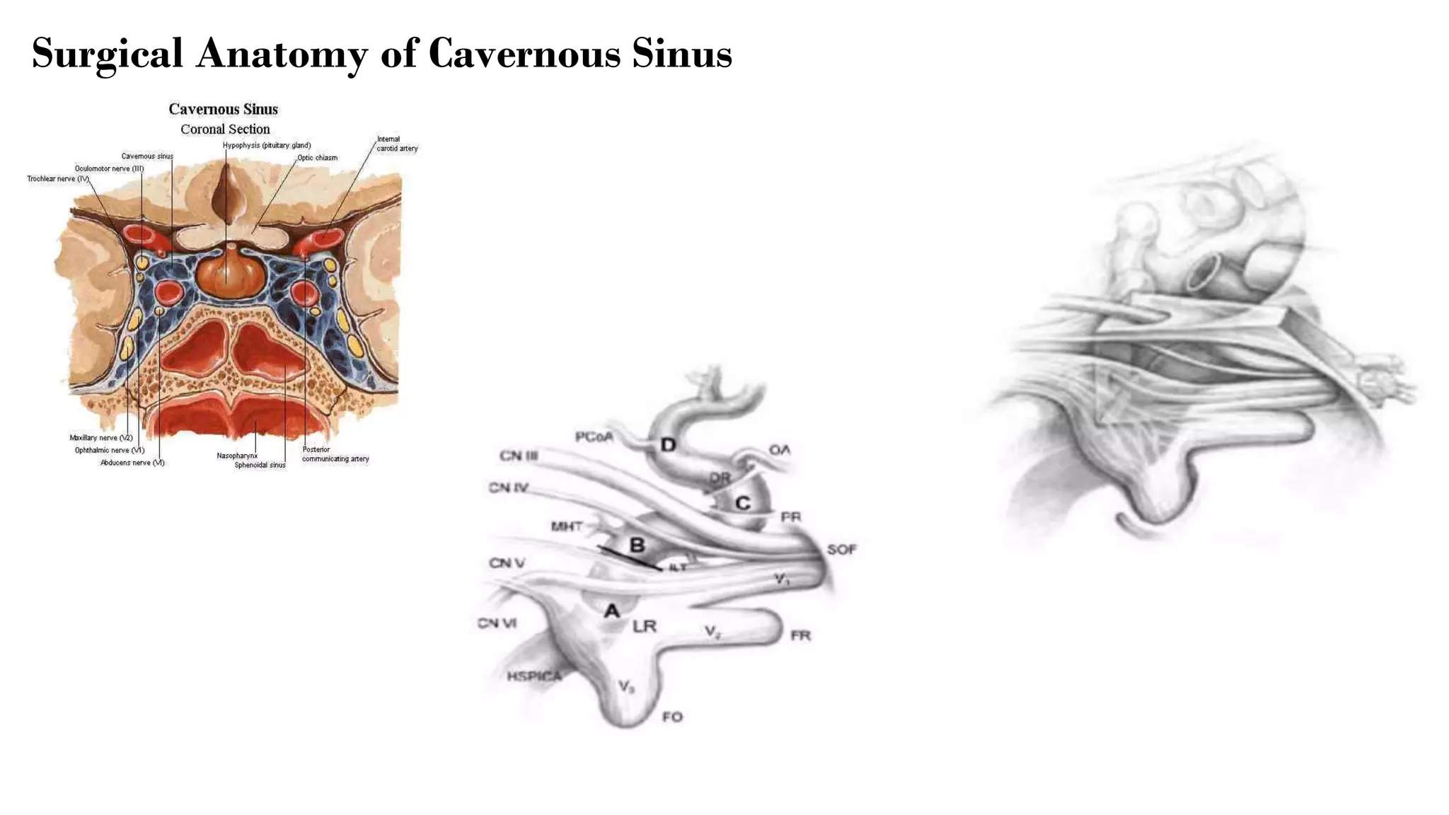 Cavernous sinus-ANATOMY AND SURGICAL APPROACHES | PPTX