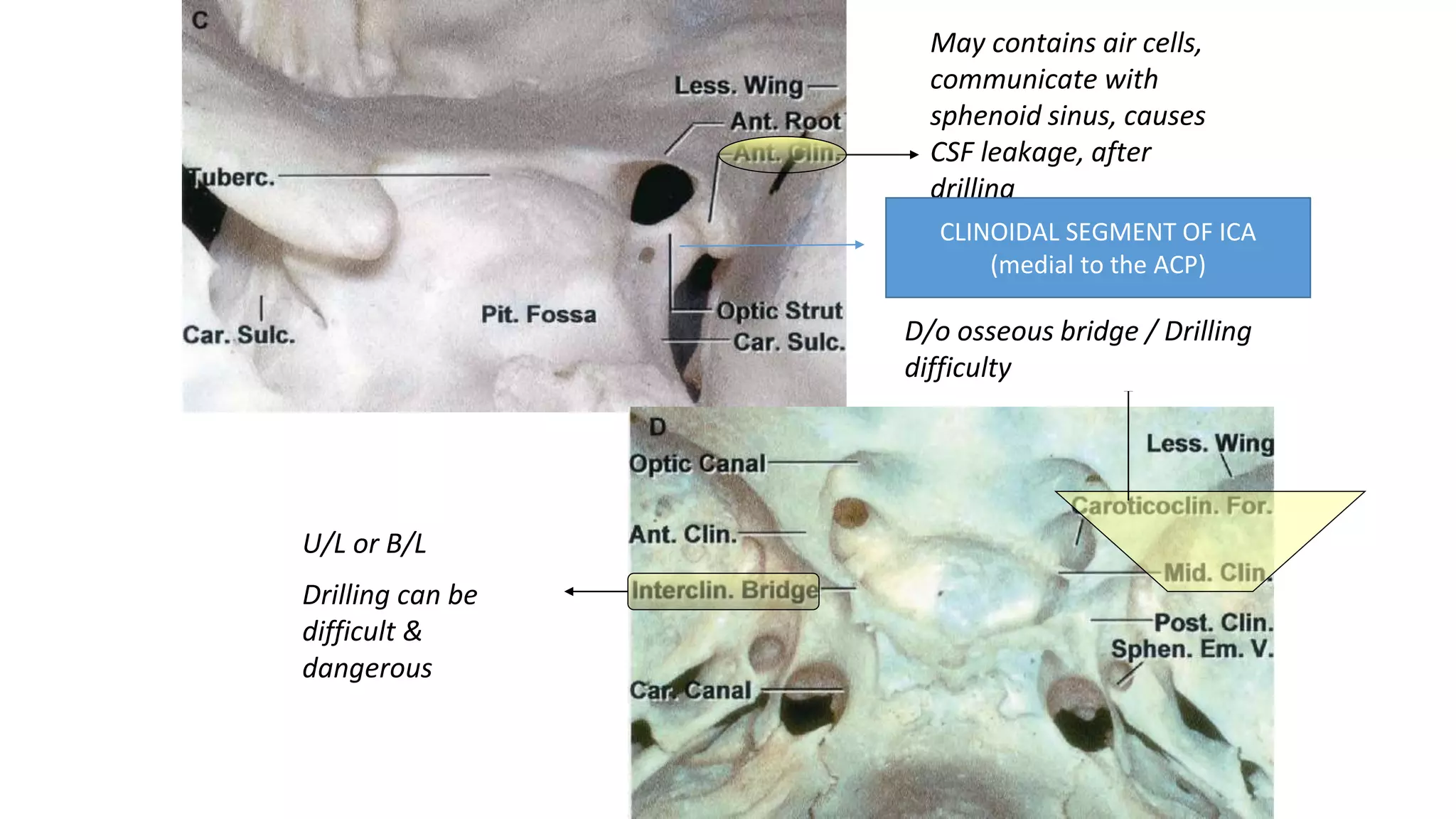 Cavernous sinus-ANATOMY AND SURGICAL APPROACHES | PPTX