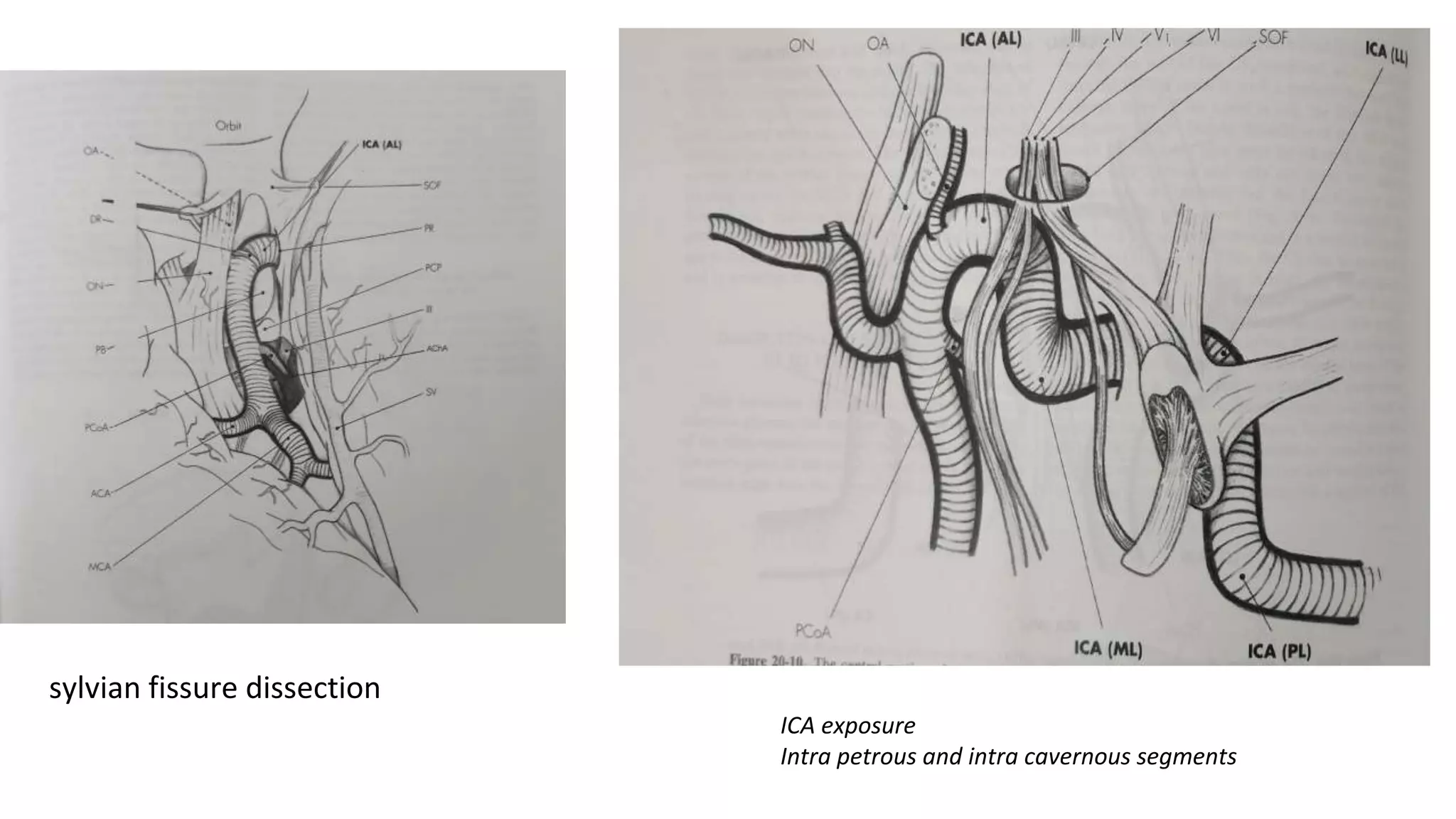 Cavernous sinus-ANATOMY AND SURGICAL APPROACHES | PPTX