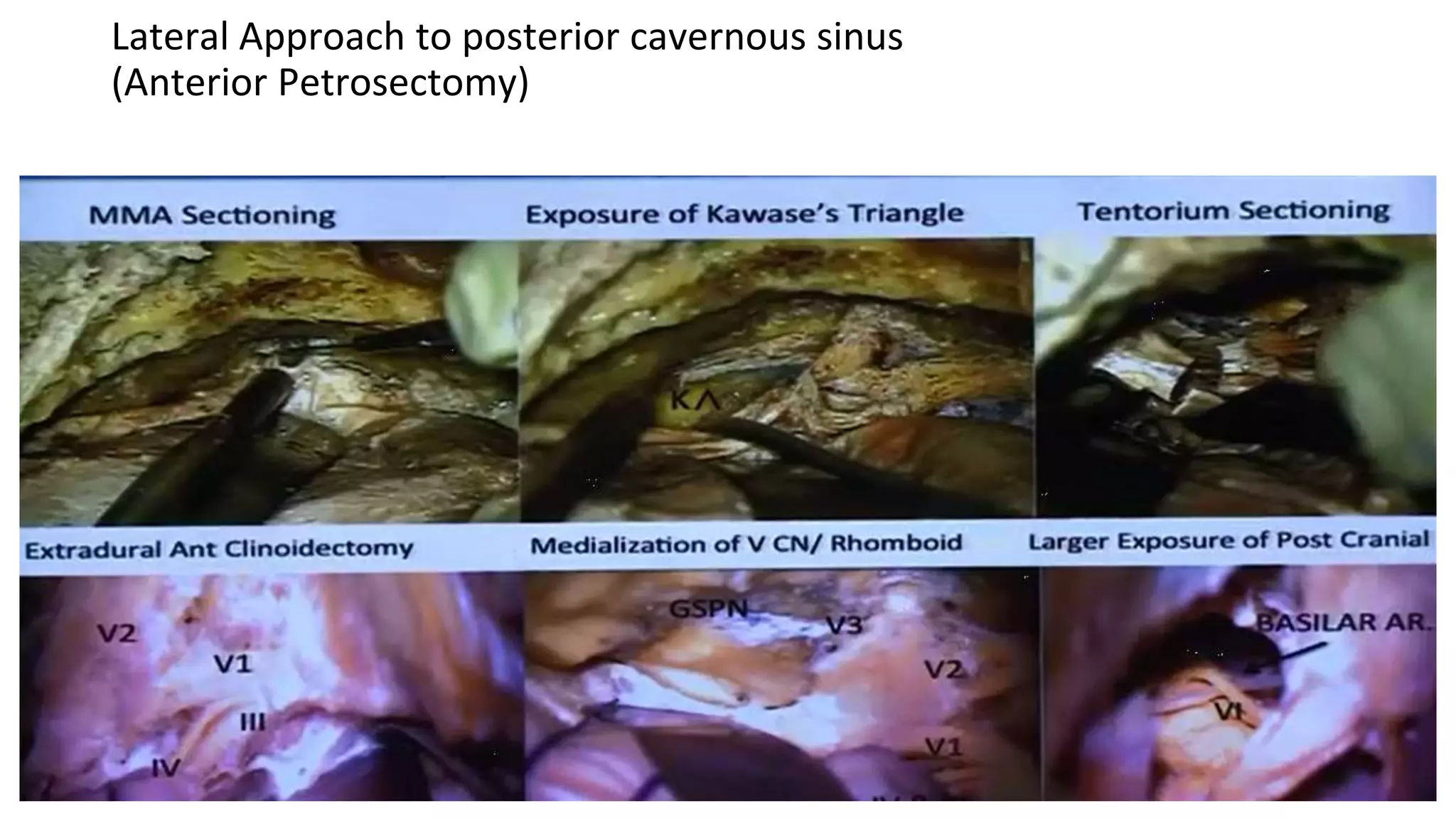 Cavernous sinus-ANATOMY AND SURGICAL APPROACHES | PPTX
