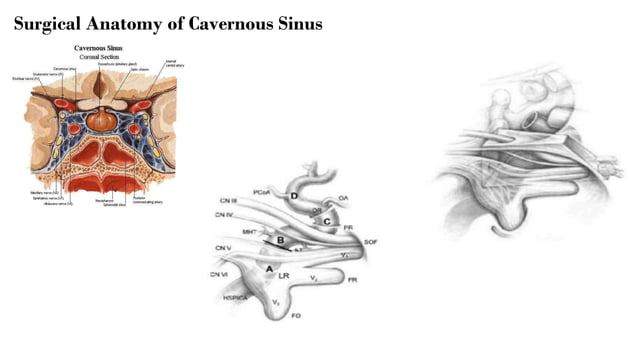 Cavernous sinus-ANATOMY AND SURGICAL APPROACHES | PPTX | Ear, Nose and ...