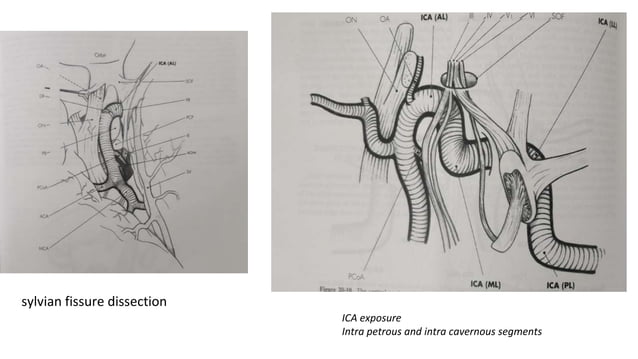 Cavernous sinus-ANATOMY AND SURGICAL APPROACHES | PPTX | Ear, Nose and ...