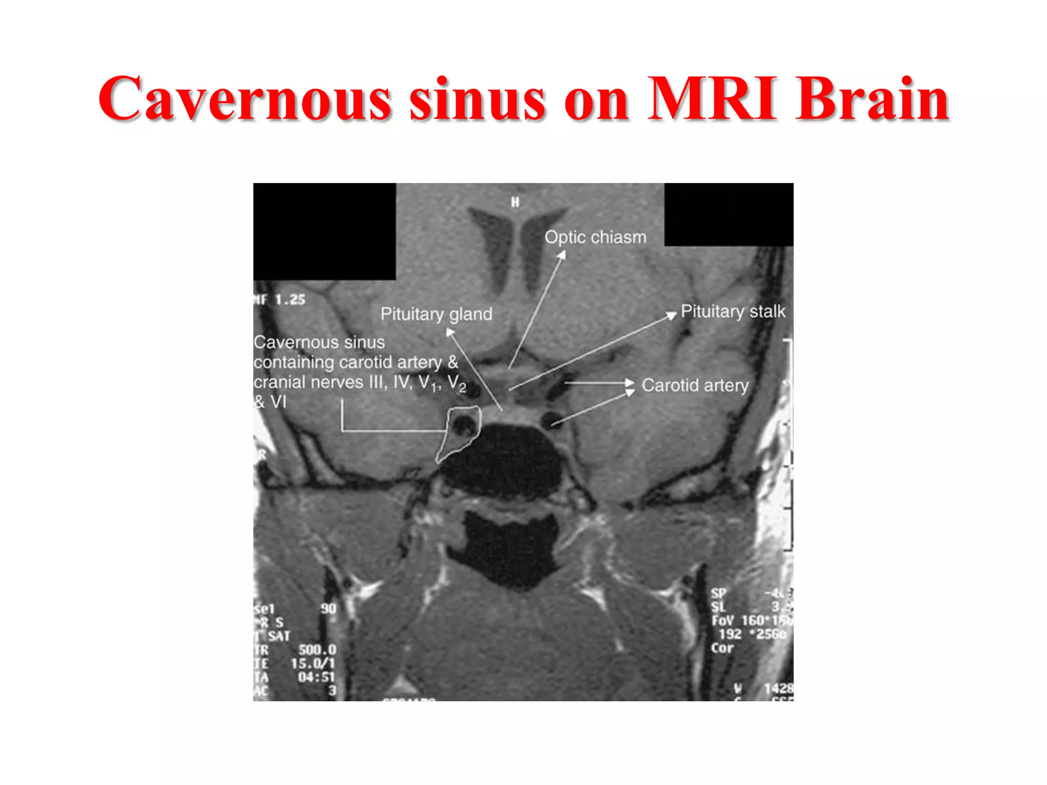 Cavernous sinus thrombosis.pdf ppt | PPTX