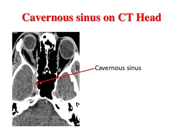 Cavernous sinus thrombosis.pdf ppt
