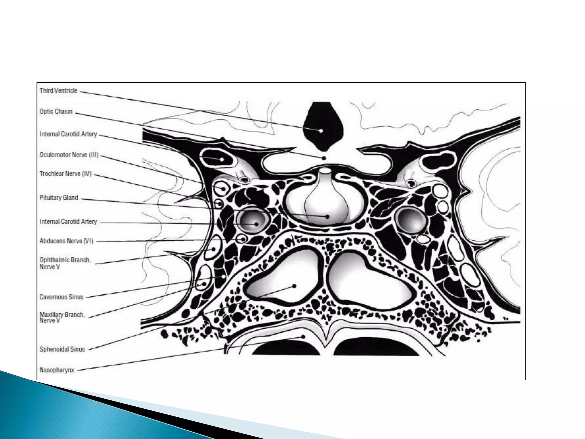 Cavernous sinus thrombosis | PPTX