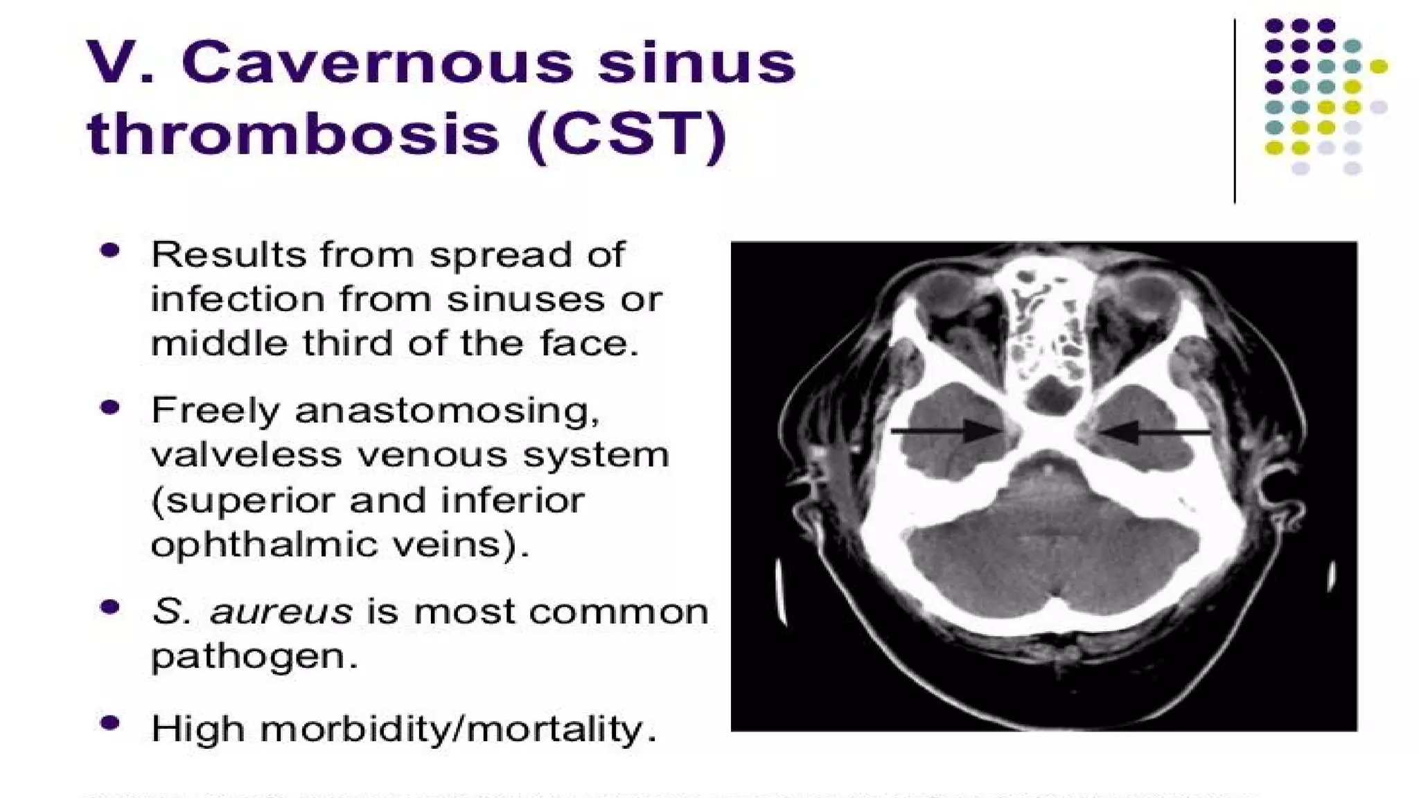 Cavernous Sinus Thrombosis | PPT