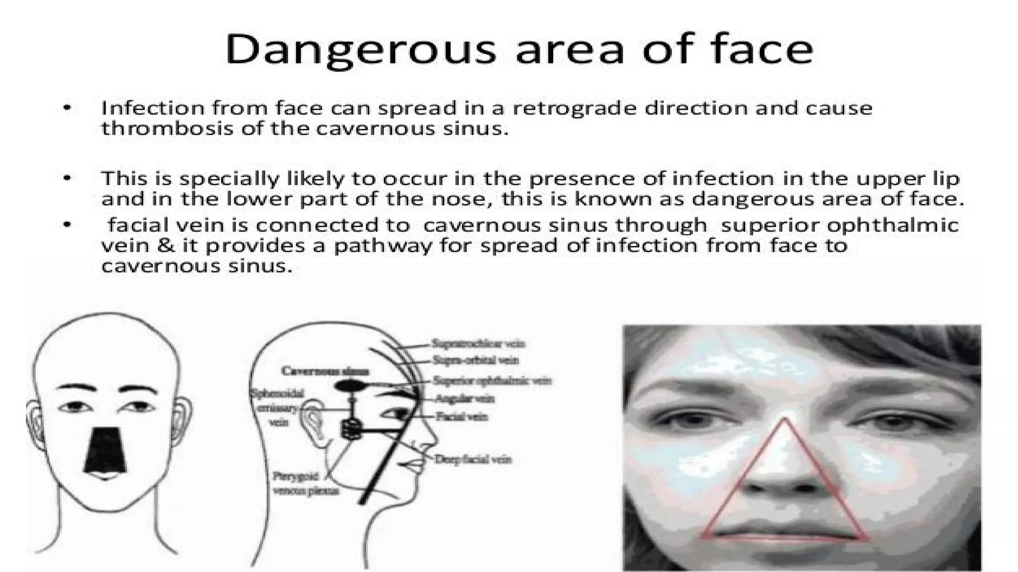 Cavernous Sinus Thrombosis | PPT