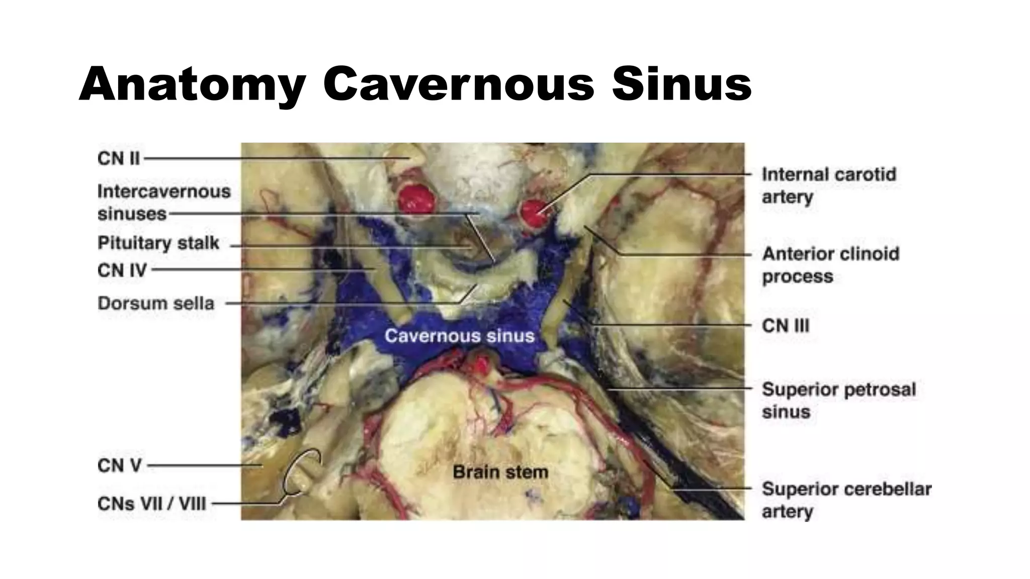 Cavernous Sinus Thrombosis | PPTX