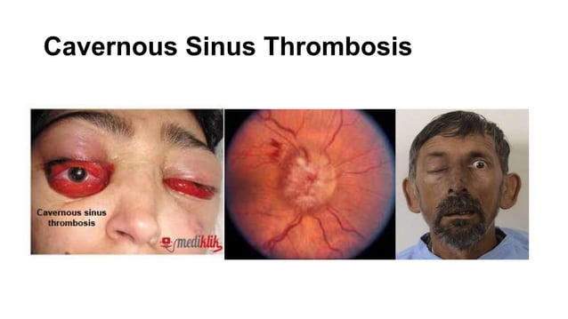 Cavernous Sinus Thrombosis | PPTX | Ear, Nose and Throat Conditions | Diseases and Conditions