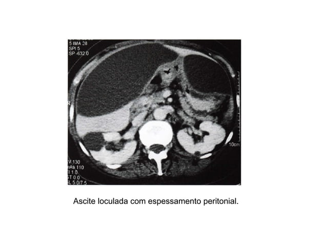 Parede Abdominal e Cavidade Peritoneal | PPT