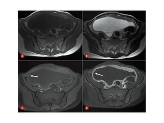 Parede Abdominal e Cavidade Peritoneal | PPT