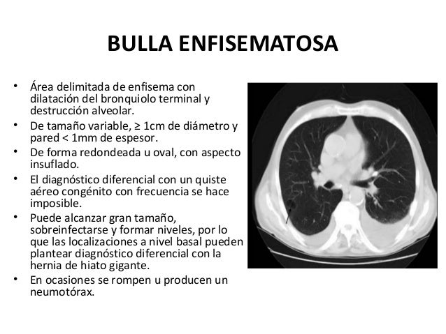 Cavidades y quistes pulmonares terminada