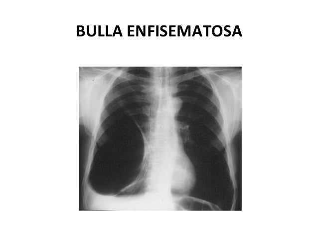 Cavidades y quistes pulmonares terminada
