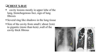 Cavitary tuberculosis | PPTX