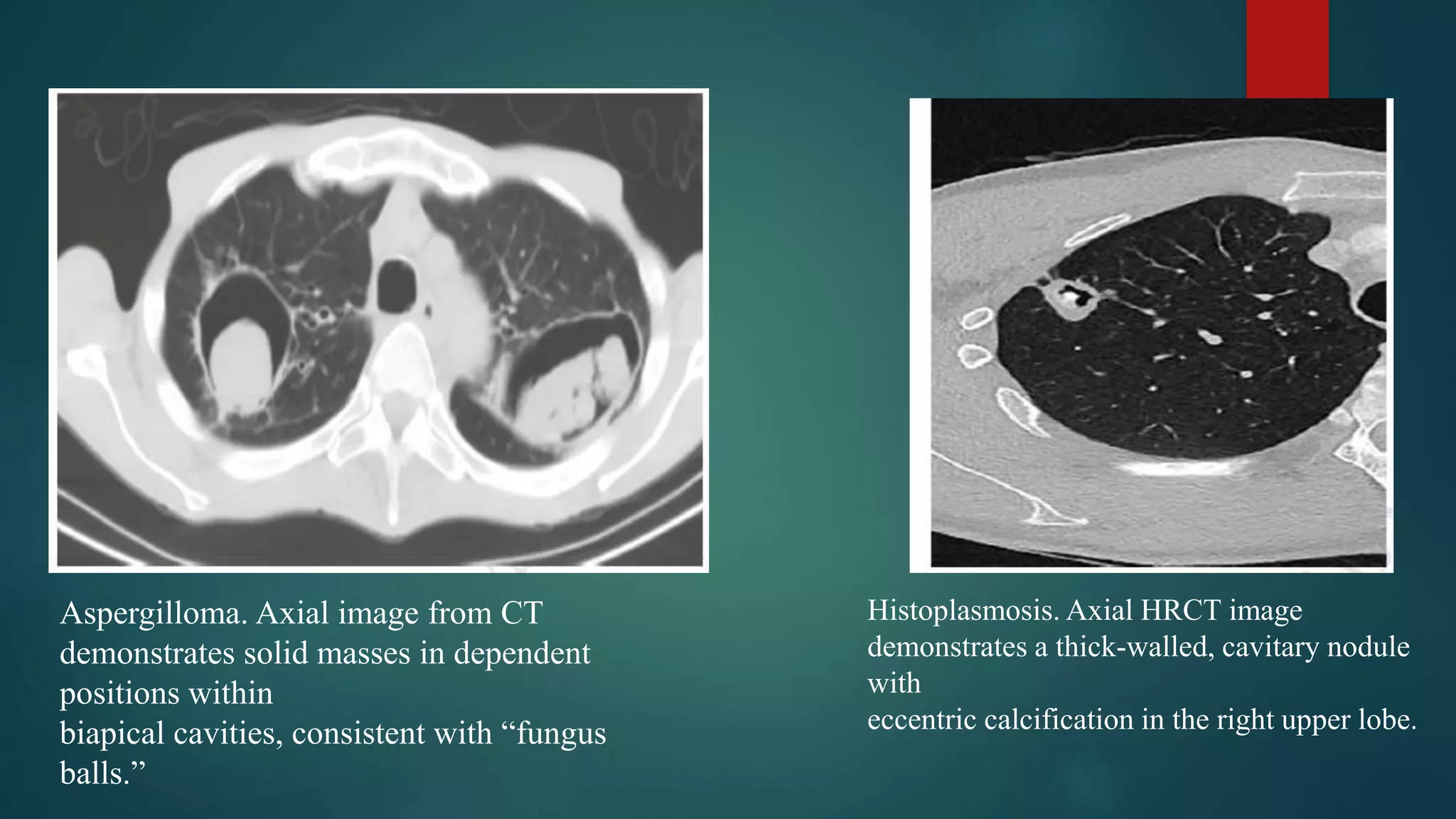 Cavitatory LUNG Disease ULTIMATE.pptx