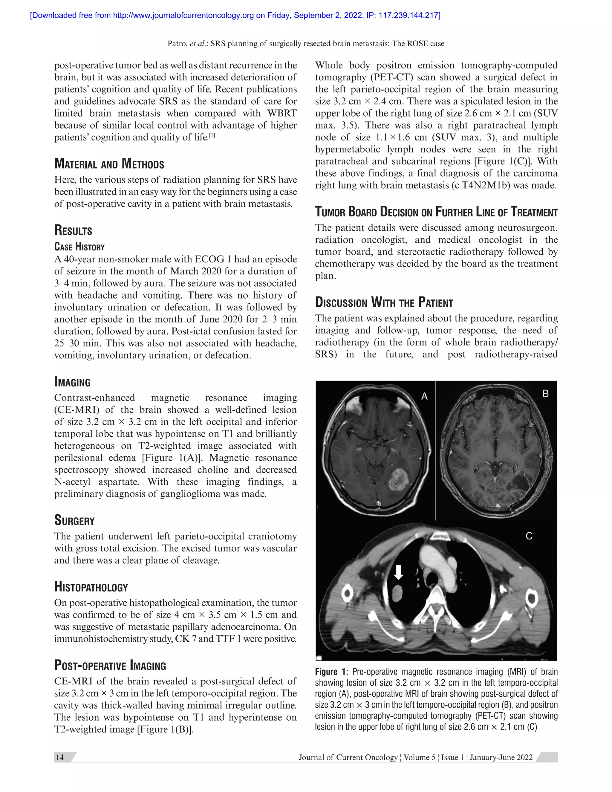 BRAIN MET CAVITY SRS ROSE | PDF