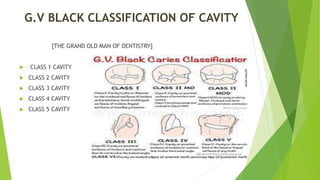 CAVITY DESIGN | PPTX
