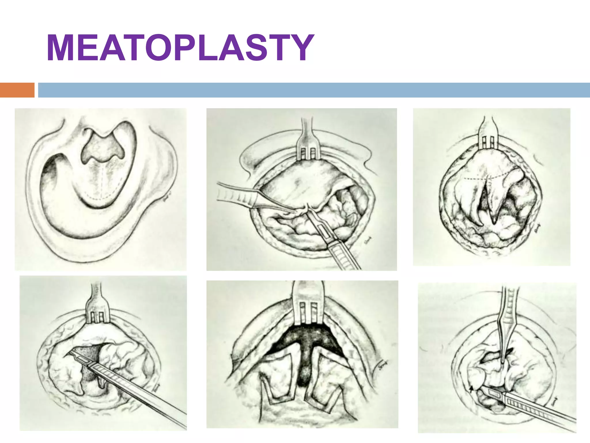 Cavity obliteration @ sayan | PPTX