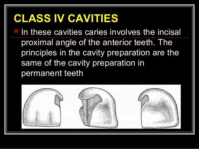 Cavity preparation