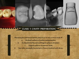 Cavity preparation class 1 | PPTX