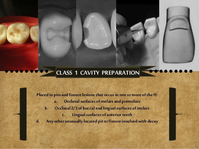 Cavity preparation class 1
