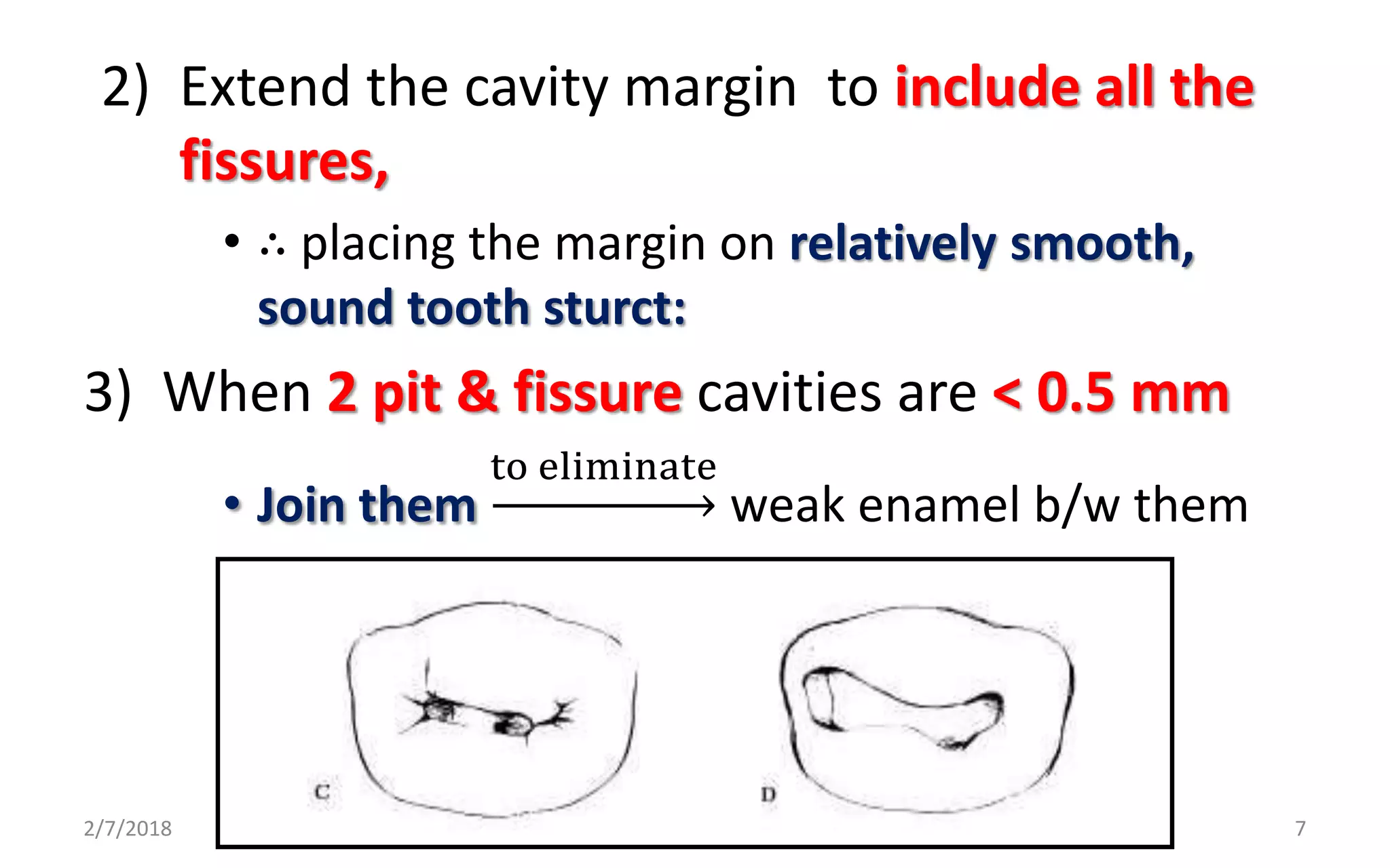 General rules for Cavity Preparations | PPT