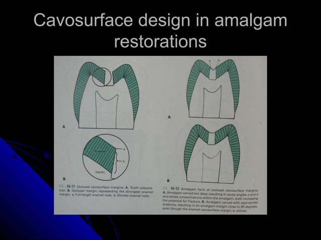 Cavosurface margins in various restorations /certified fixed ...