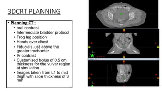 Carcinoma Vulva Planning Meet : 09/22/18 | PPT