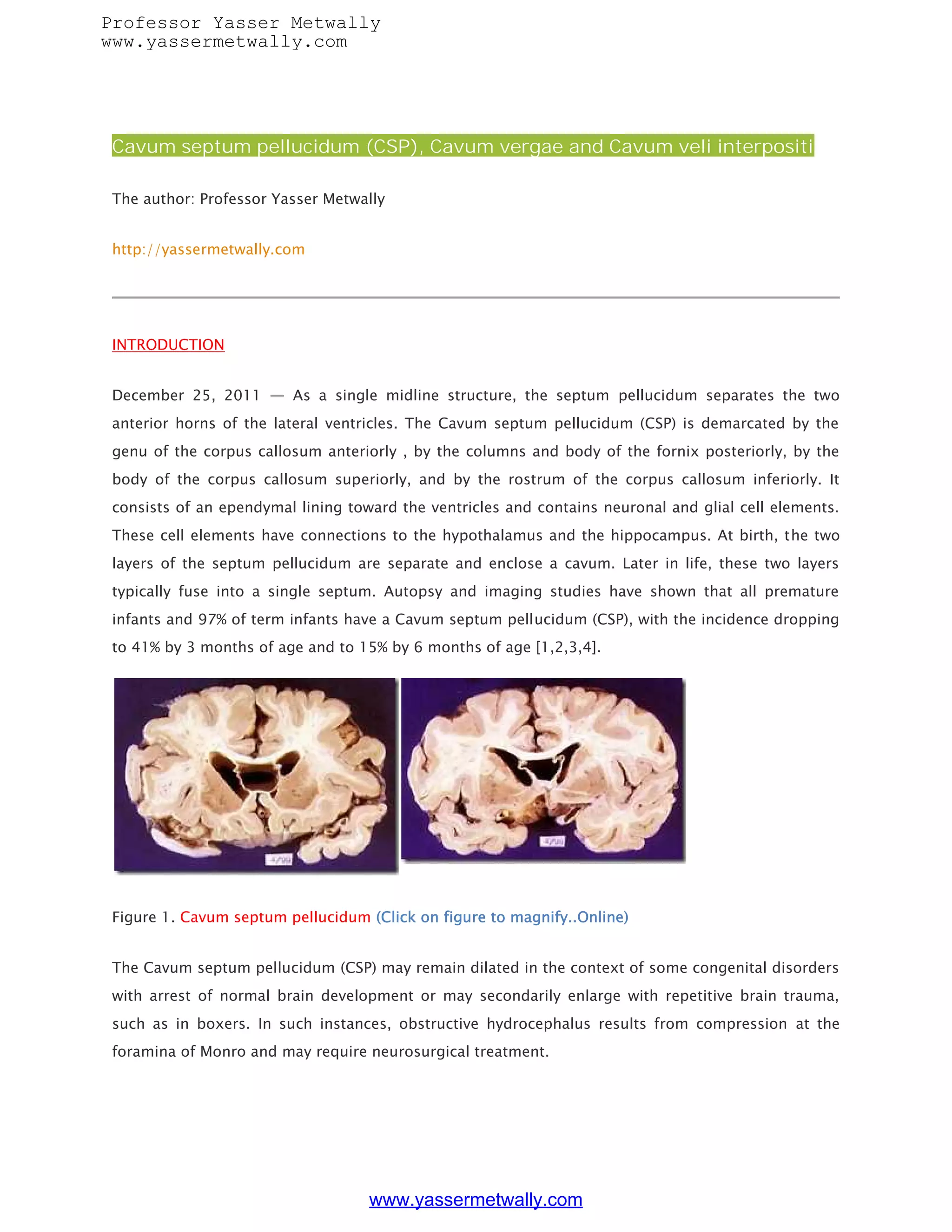 Cavum septum pellucidum (CSP), Cavum vergae and Cavum veli interpositi ...