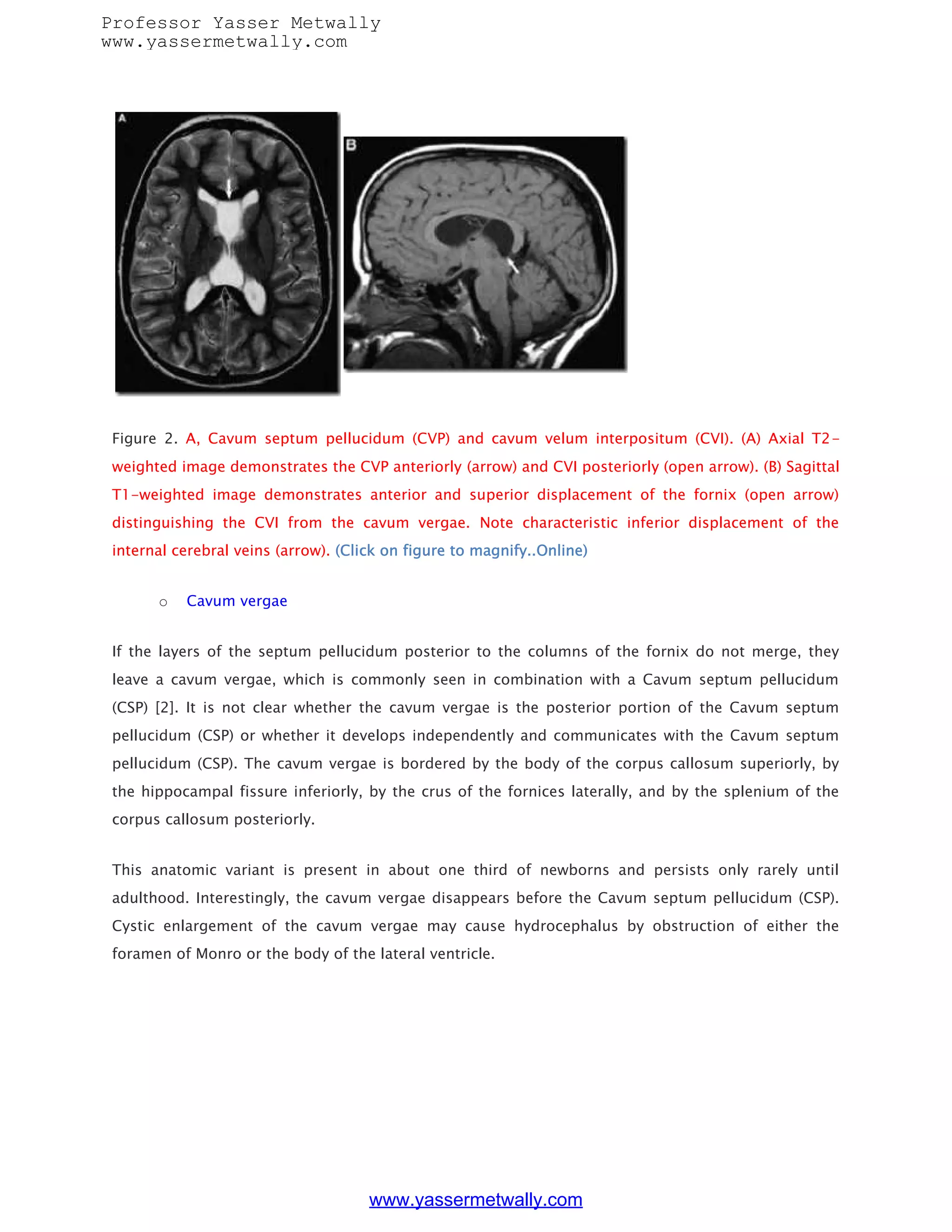 Cavum septum pellucidum (CSP), Cavum vergae and Cavum veli interpositi ...