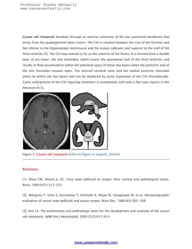 Cavum septum pellucidum (CSP), Cavum vergae and Cavum veli interpositi ...