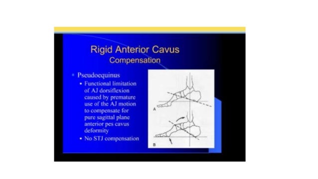 Cavus foot
