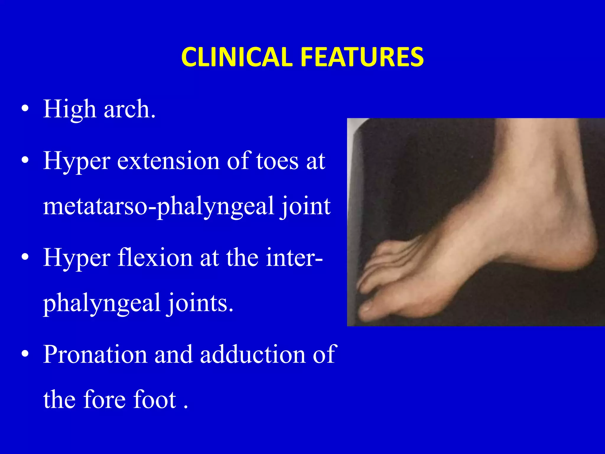 Flat foot and Cavus foot | PPTX
