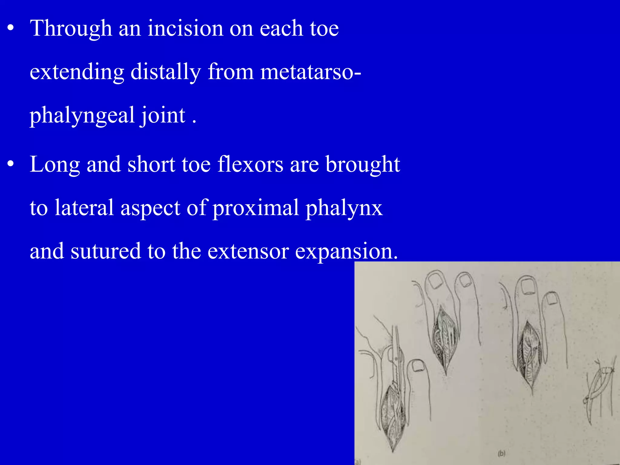 Flat foot and Cavus foot | PPTX