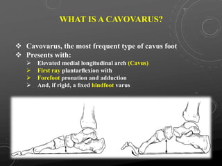 Cavuvarus foot deformity by abdulrhman alnasser | PPT